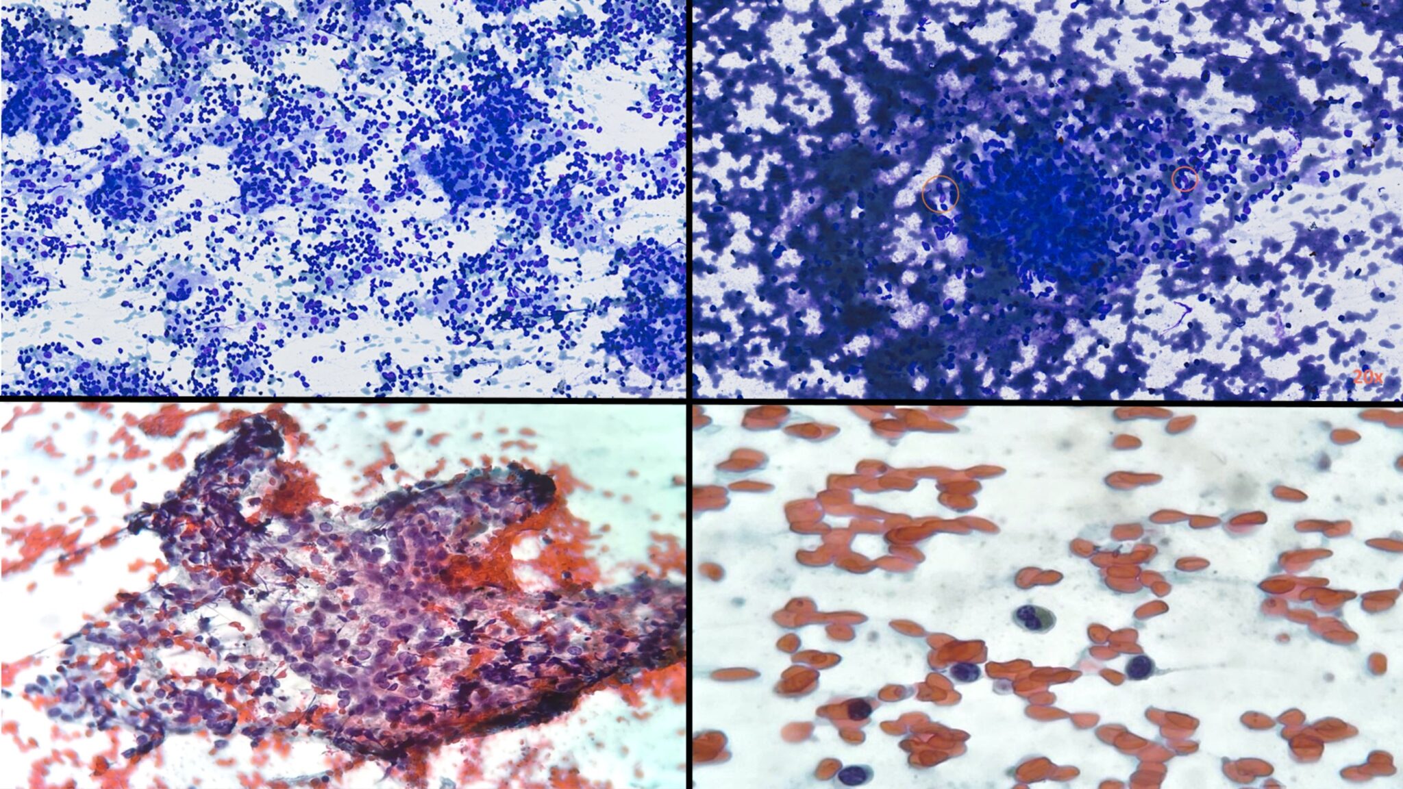 Diagnóstico citológico mediante PAAF-EBUS de Histiocitosis de células ...
