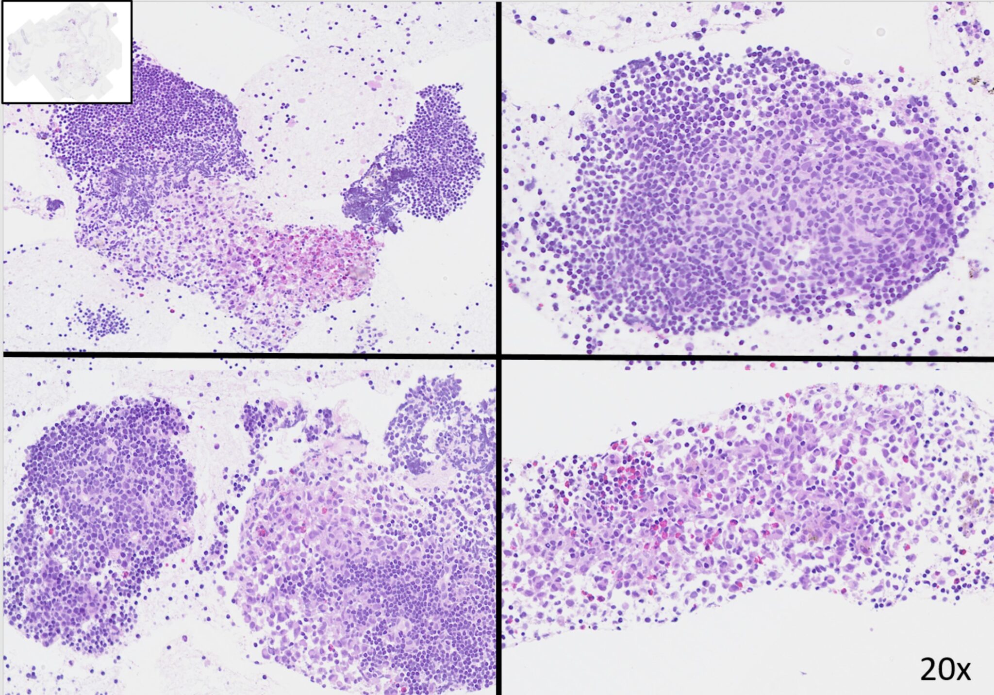 Diagnóstico citológico mediante PAAF-EBUS de Histiocitosis de células ...