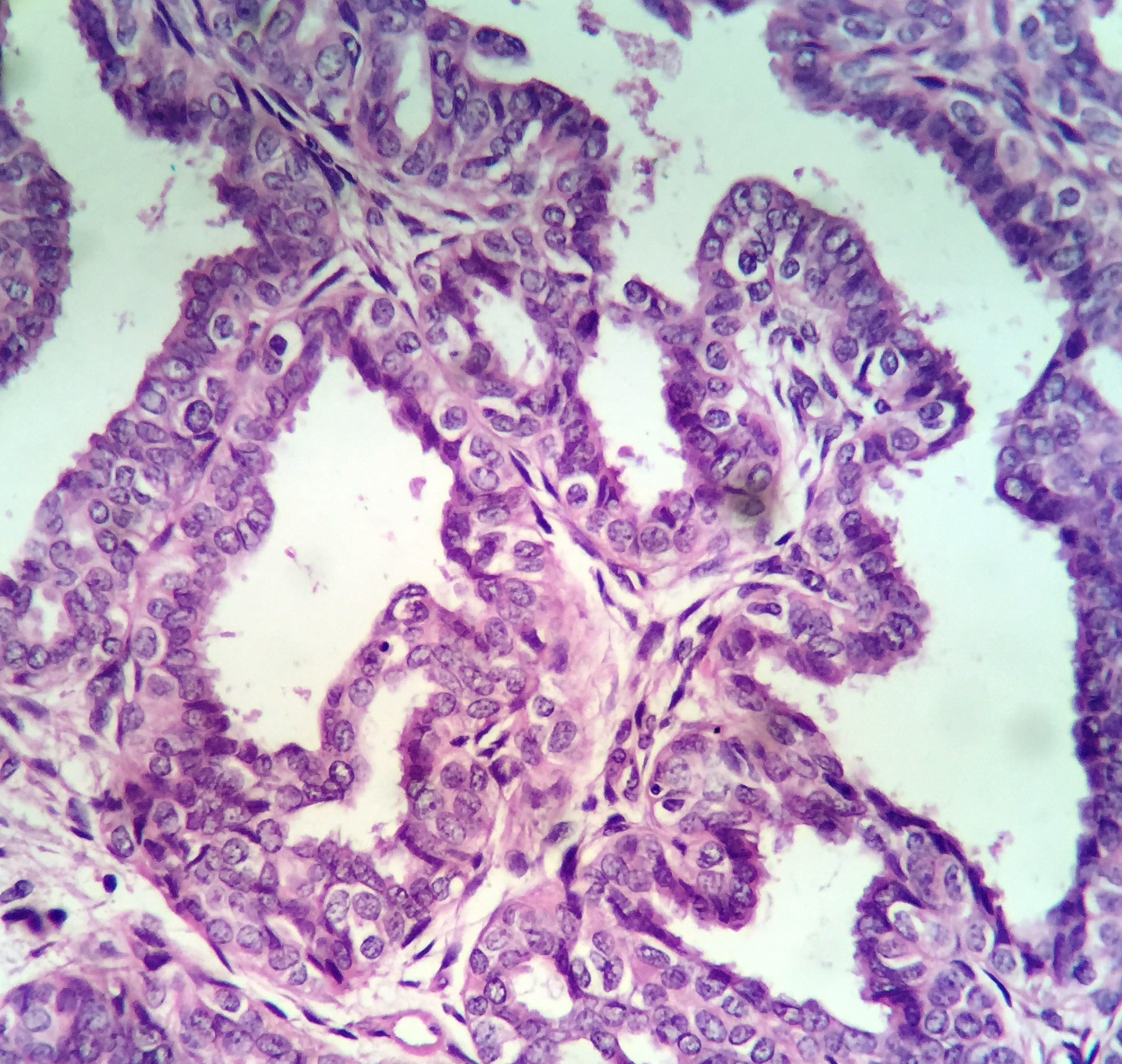 Papiloma intraductal de mama, el rol de la PAAF como herramienta ...